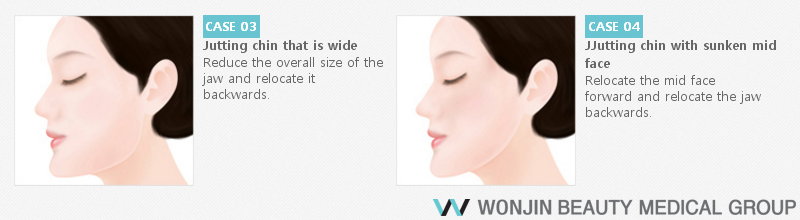 Korea Two Jaw Surgery Wonjin Beauty Medical Group - Jutting Jaw ...