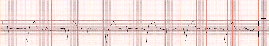 EKG Rhythm Strip Quiz 56: Paced Rhythms