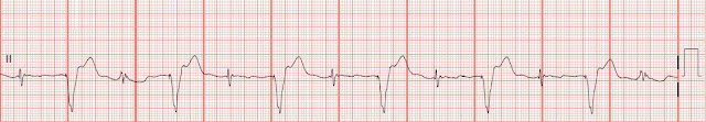 EKG Rhythm Strip Quiz 56: Paced Rhythms