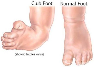 What caused Clubfoot in newborn to occur? - Baby Care Tips