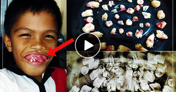 Meet A 9-Year-Old Boy Who Has 300 Teeth | Onlin Khabar 24