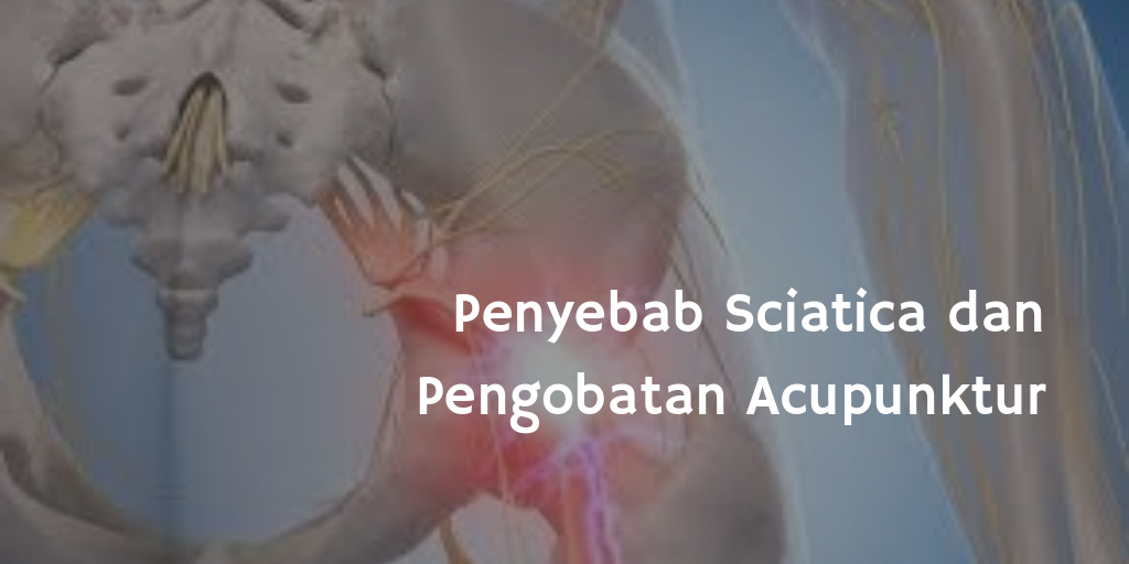 Penyebab Sciatica dan Pengobatan Acupunktur - Terapi Jarum