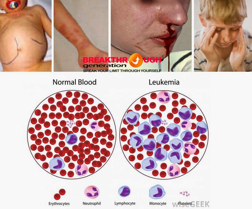 1ST STEP in UNDERSTANDING the BODY: LEUKIMIA/ KANKER DARAH