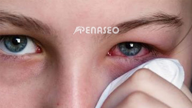 3 Cara Mengobati Mata Merah Sebelah Paling Aman - Penaseo