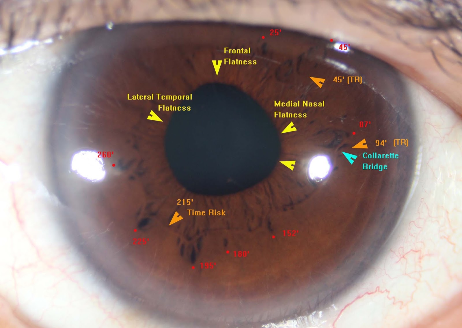 Modern & Multidimensional Iridology: Pupil Flattenings, Collarette ...