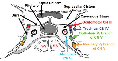 Cavernous Sinus Thrombosis-Signs symptoms-Diagnosis-Treatment and ...