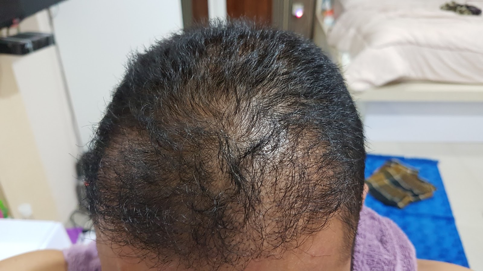 hair transplant experience - pengalaman transplantasi rambut / tanam ...