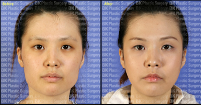 BK Plastic Surgery: [BK Plastic Surgery] Paranasal Augmentation
