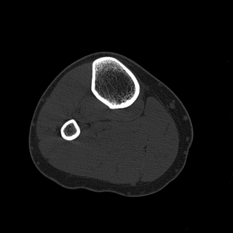 CT Knee - Radiology Imaging