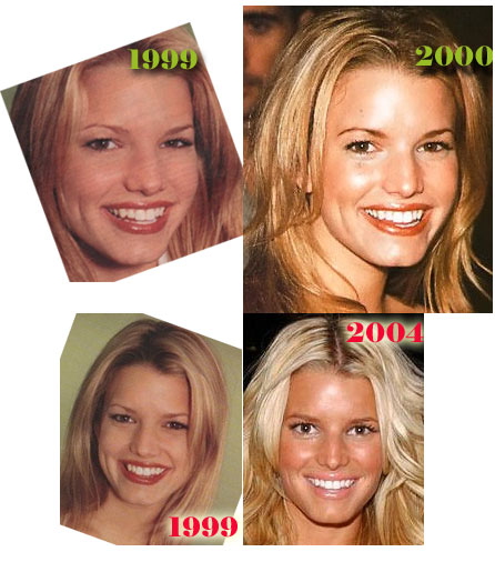 Jessica Simpson Plastic Surgery