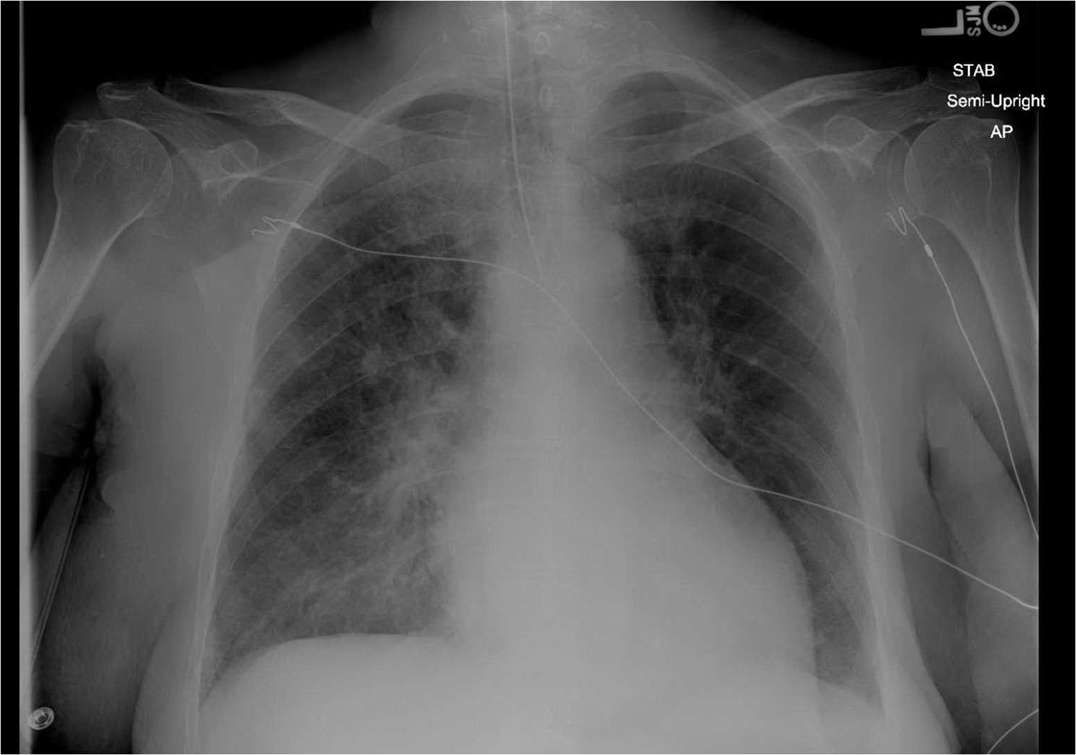 Cardiogenic Pulmonary Edema X Ray