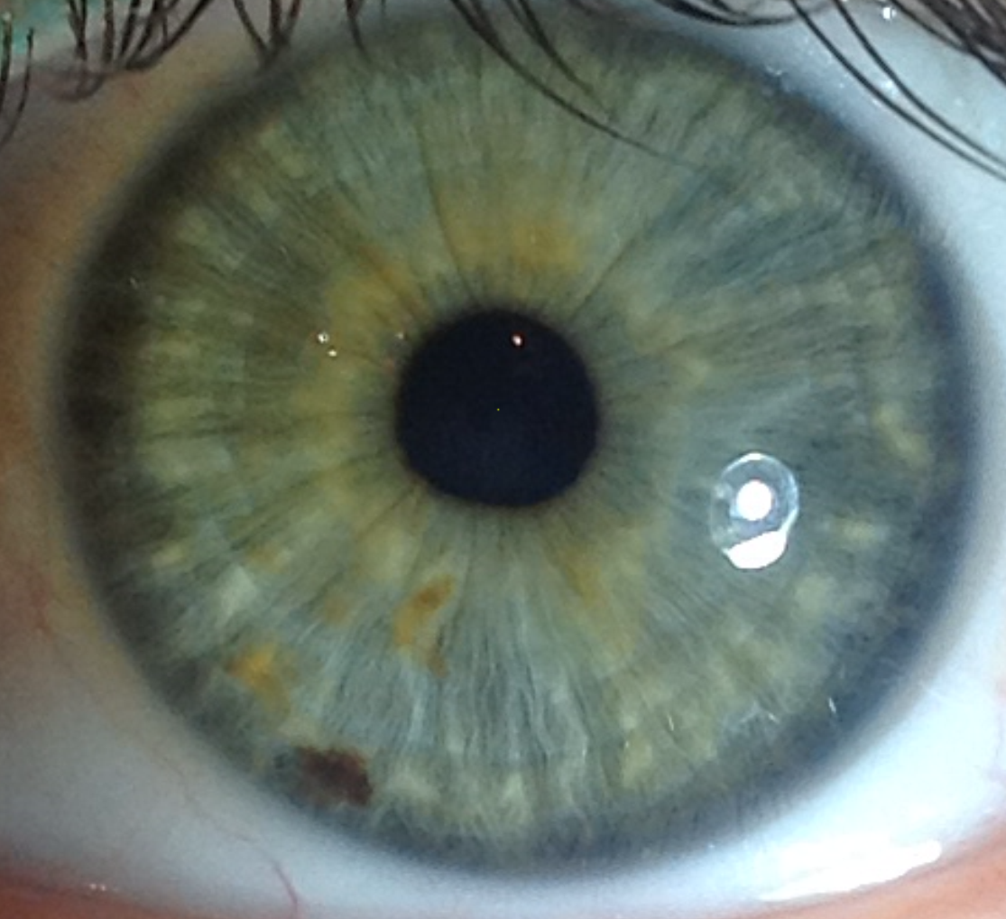 Modern & Multidimensional Iridology: Radial Furrows at Pupillary Zone ...
