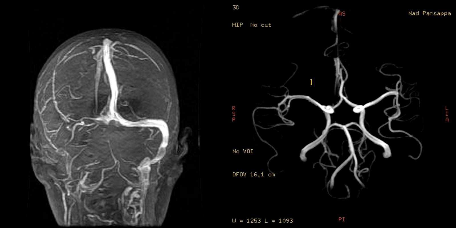 Dr Balaji Anvekar Frcr Unusual Sigmoid Sinus Lesion