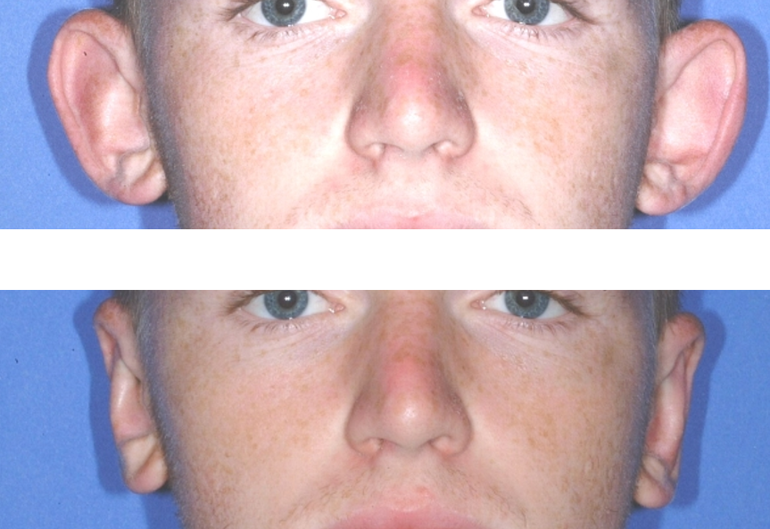 Indiana Plastic Surgery Center - Robert Severinac, MD: Otoplasty (Ear ...