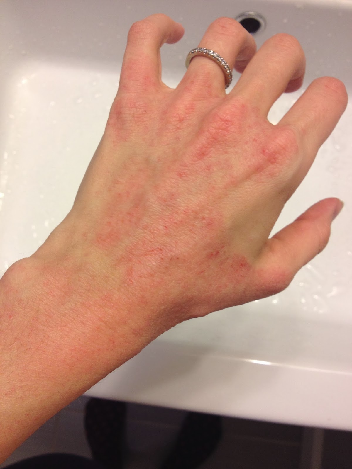My journey with itchy skin.: Flare (mini-flare)? + pictures