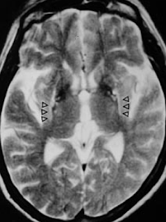 NeuroAnatomía Dr. William Ganem: Signo de la cruz en el puente