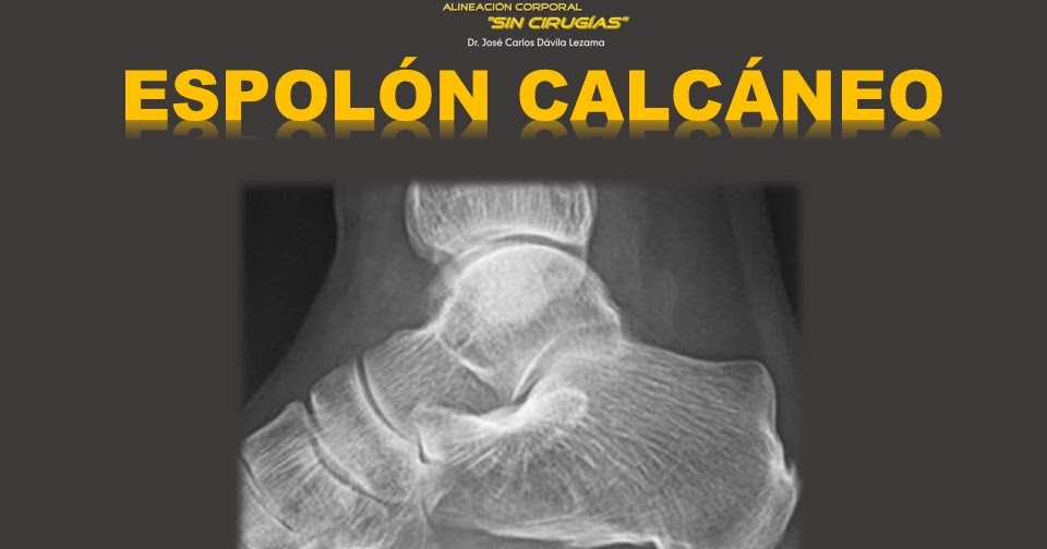 SIN CIRUGÍAS en LÍNEA: ESPOLÓN CALCÁNEO...esa molesta espinita.