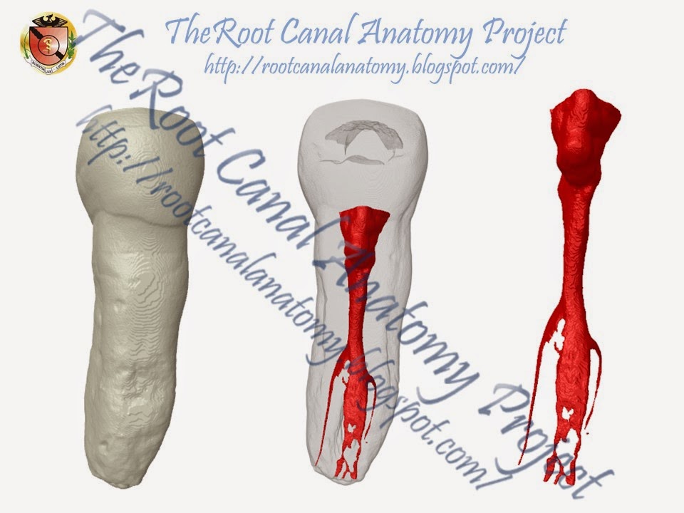 The Root Canal Anatomy Project: C-Shaped Mandibular First Premolar