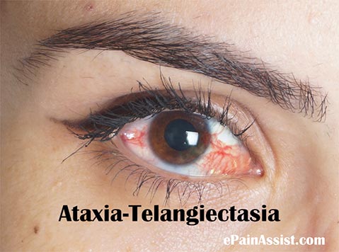 Ataxia-telangiectasia ou Síndrome de Louis-Bar