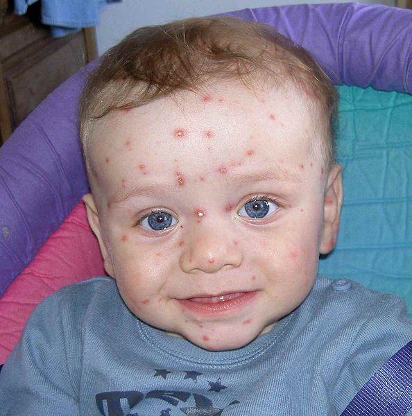 Evidence-Based Mommy: The End of Chicken Pox?