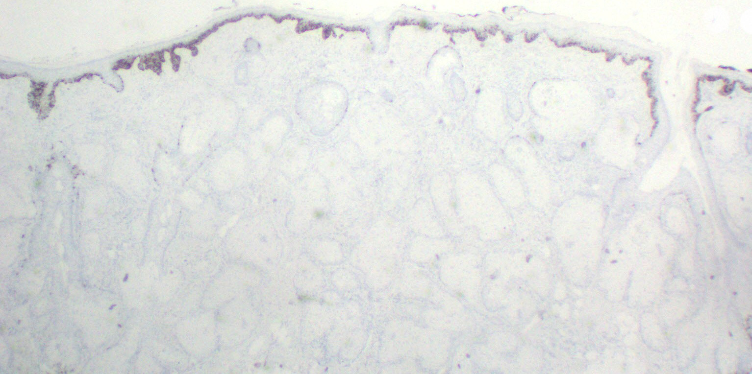 VIRTUAL GRAND ROUNDS IN DERMATOLOGY 2.0: Whose Nose Needs Mohs?