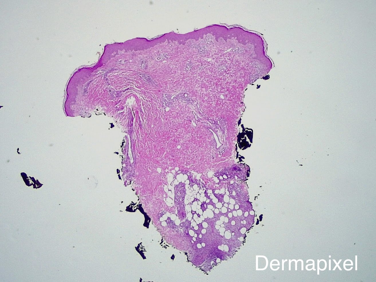 Histologiadeleritemaindurado