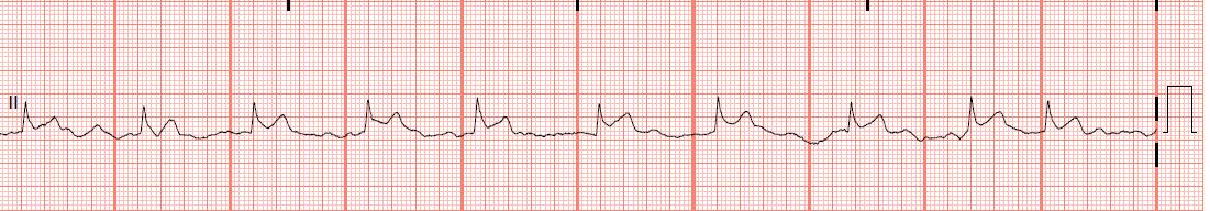 Float Nurse: EKG Rhythm Strips 56: Atrial Fibrillation