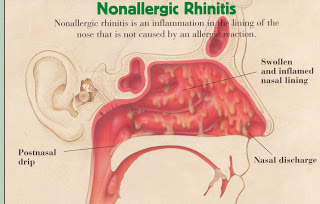 Non-allergic rhinitis