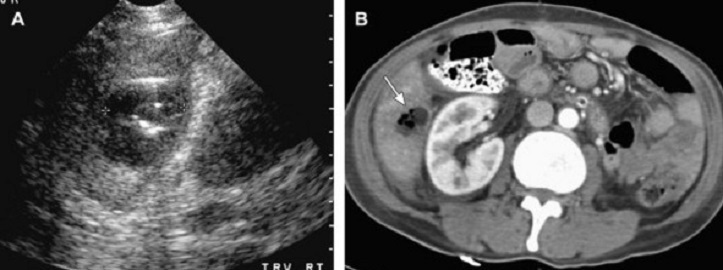 Liver abscess ultrasound, hypoechoic cystic lesion in the liver ...