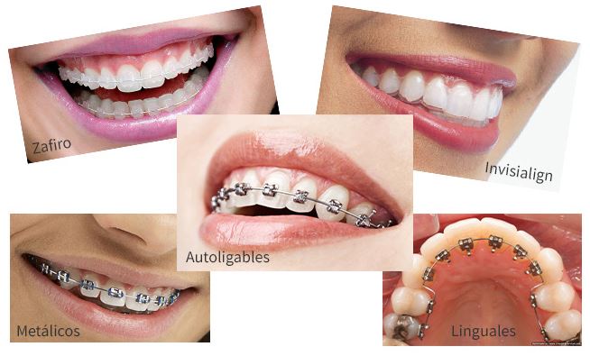 Tipos de Brackets y sus diferencias - Brackets Veracruz | Ortodoncia y ...