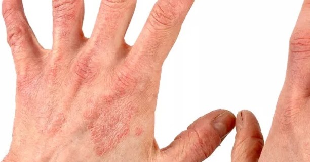 Berbagai Jenis Penyakit Autoimun dan Cara Mengobatinya - Biologizone