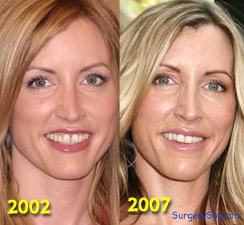 Heather Thomas Plastic Surgery Botox Before and After | Plastic Surgery