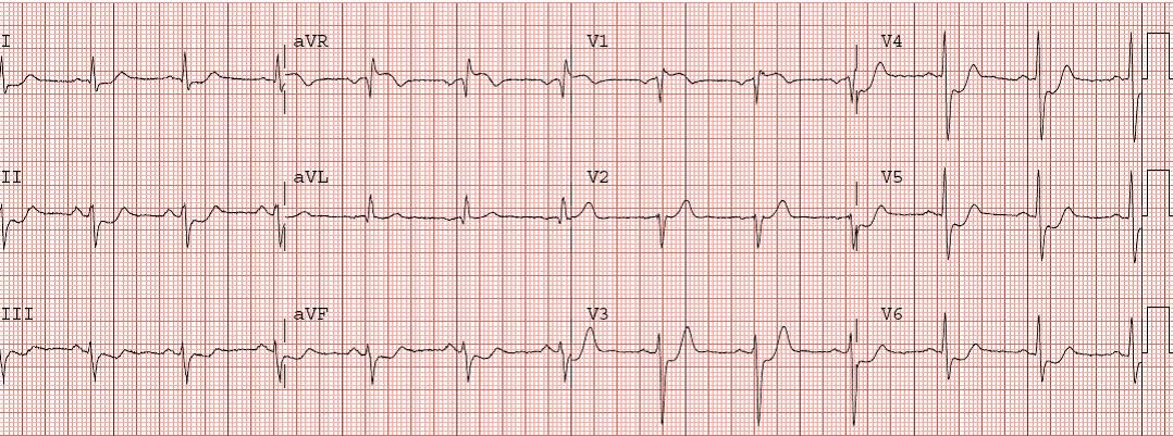 Dr. Smith's ECG Blog: January 2010