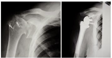 Medical Treatment Pictures-for Better Understanding: Shoulder ...