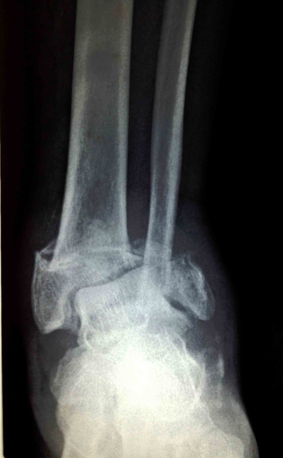 O R T O C R I T I C A: Fractura Metafisiaria distal de tibia no ...