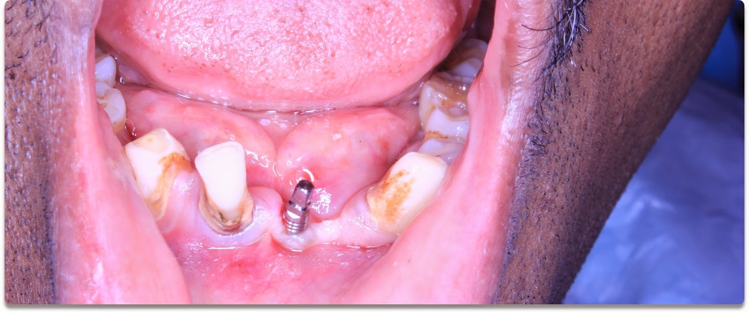 Dental implant in lower front teeth region with zirconium bridge