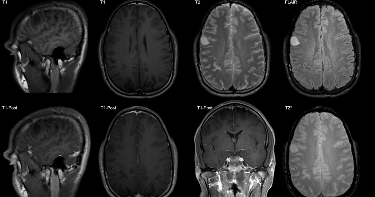 Roentgen Ray Reader Low Grade Astrocytoma