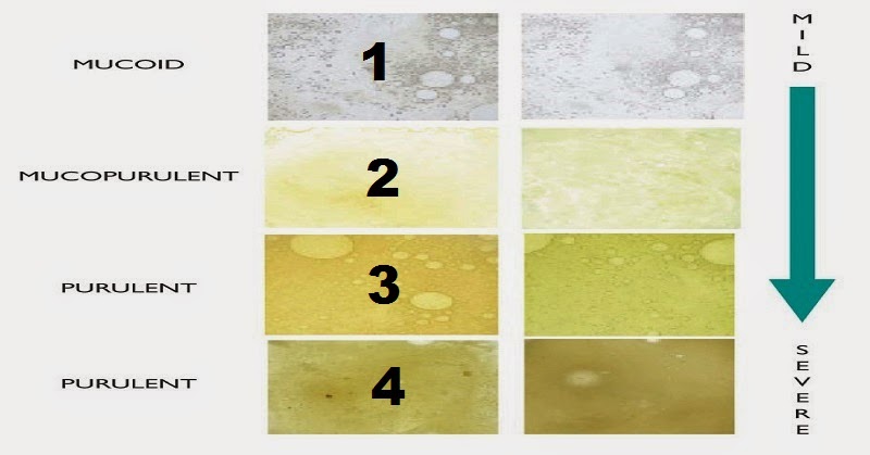 infoplus: Ce que la couleur de vos sécrétions nasales dit sur votre santé