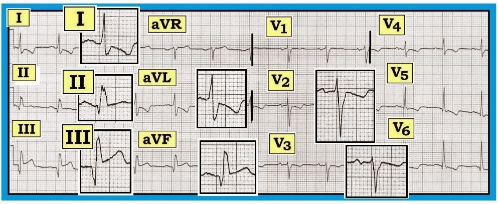 ECG Interpretation: ECG Blog #80 — CP & Coronary Anatomy