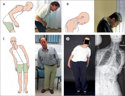 Our Parkinson's Place: What you need to know about dystonia