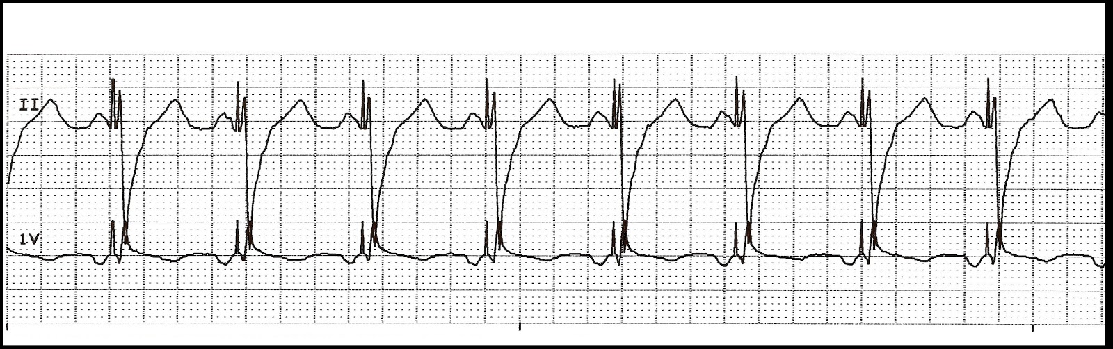 EKG Quiz 324
