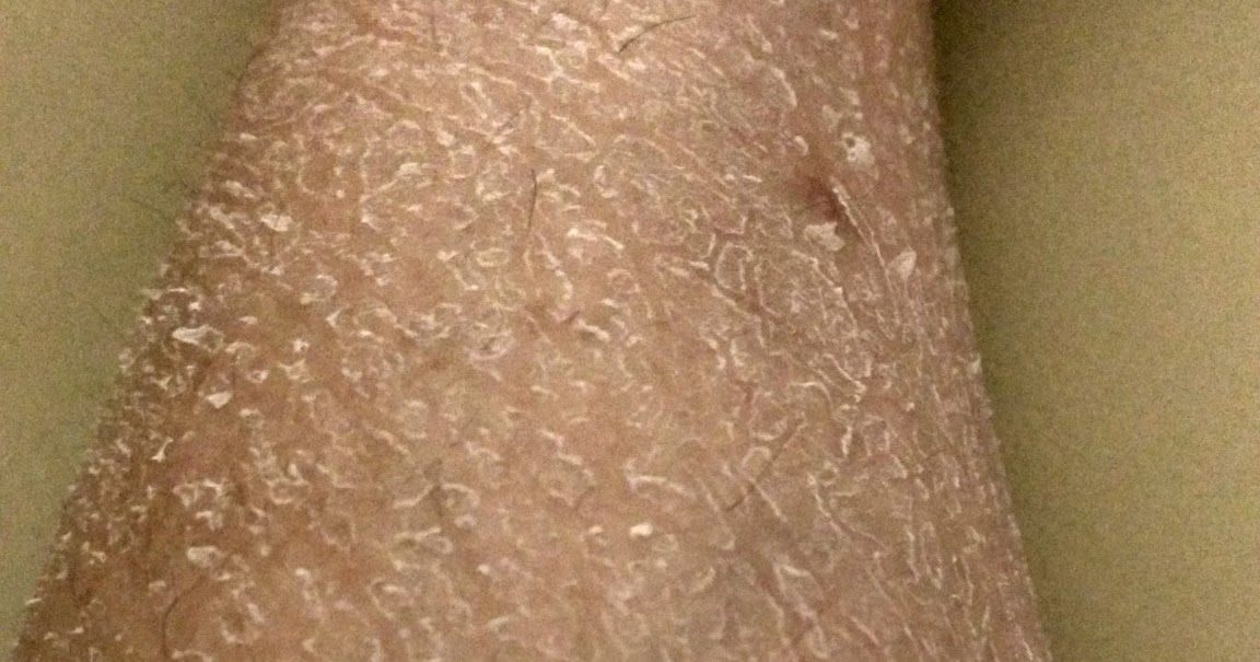 Coping with Ichthyosis: 26112017 Skin shedding day?