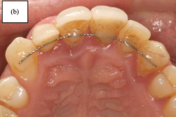 James R. Waters, DDS, MSD, PA: Closing space between upper teeth (and ...