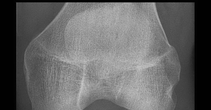 Radiology Archives: Κάταγµα Segond*