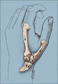 Medical Treatment Pictures-for Better Understanding: Arthroscopic Thumb ...