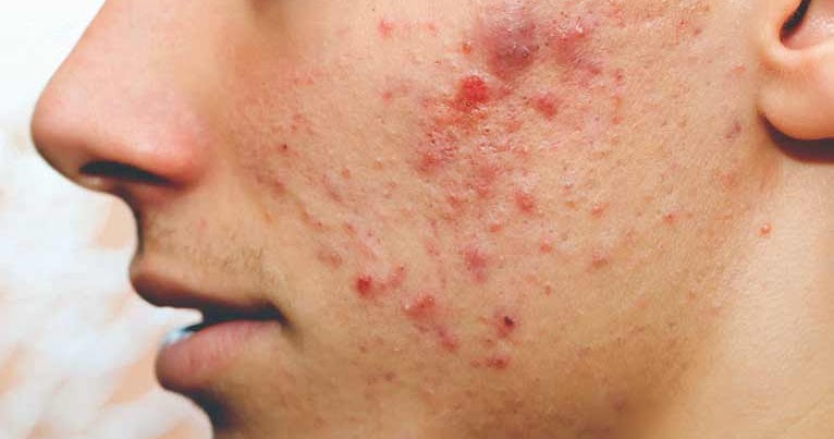 5 Cara Hilangkan Resdung Di Muka Dengan Cepat Dan Berkesan - Health is ...