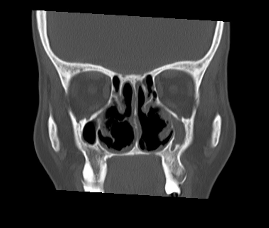 Nasal Turbinates Xray