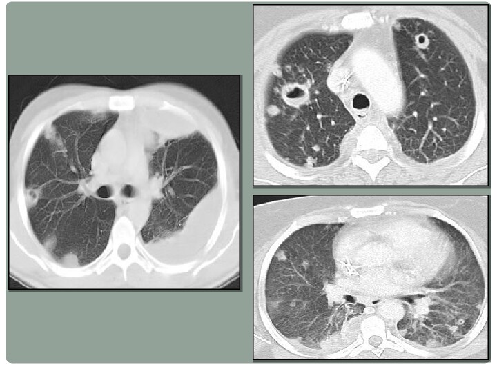 Chest Medicine Made Easy-Dr Deepu: Feeding vessel Sign