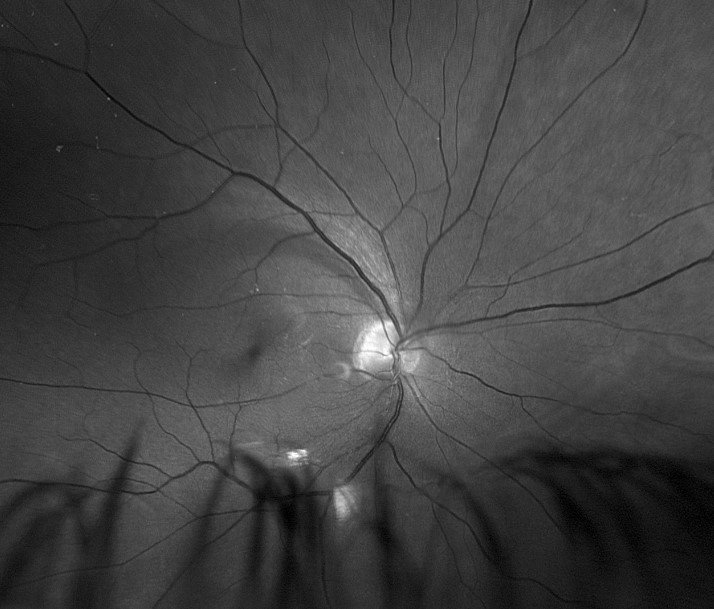 Sonoran Desert Eye Center: WEDGE DEFECT REVEALS NERVE FIBER LOSS