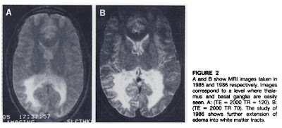 Adrenoleukodystrophy: Diagnostics